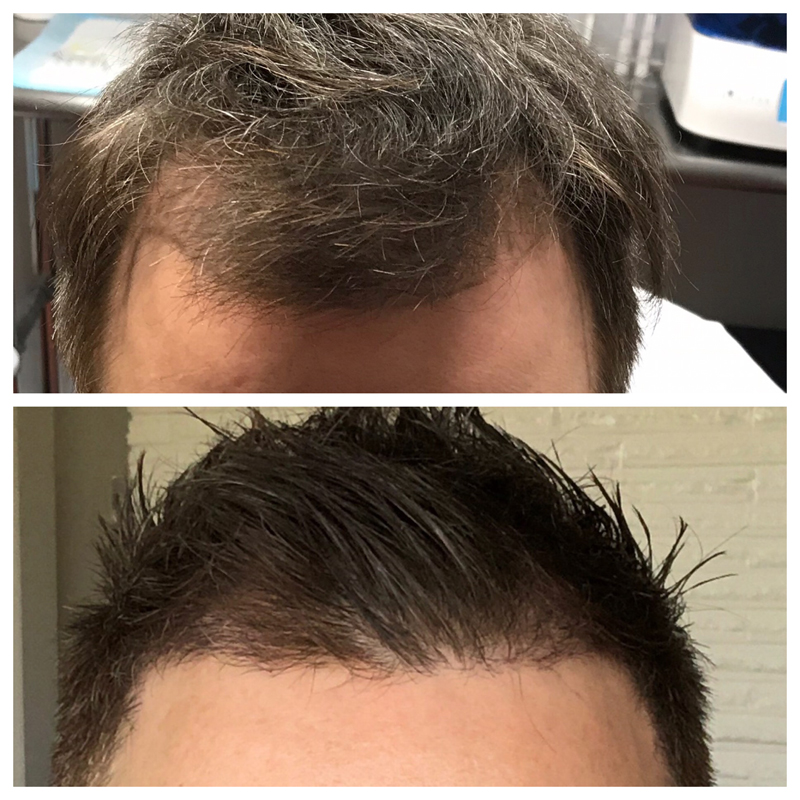 Hair Restoration - Best Hair Restoration and Transplant in San Jose ...